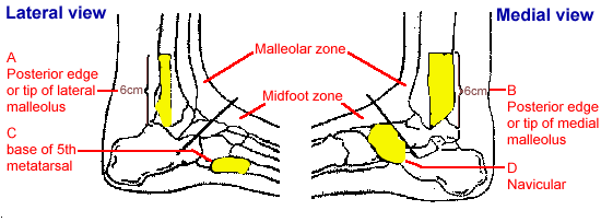 Tiny Tip: The Ottawa Ankle and Foot Rules - To Image or Not to Image ...